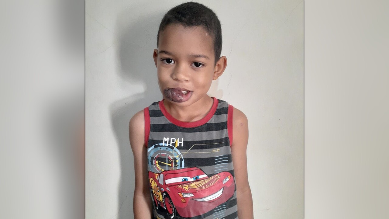 Help Little Jose have surgery in the Dominican Republic (USA) by PAL ...